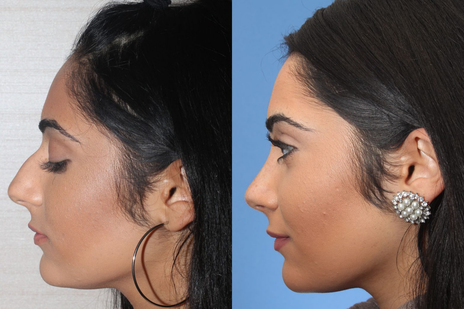 Rhinoplasty Surgery in Toronto - Solomon Facial Plastic