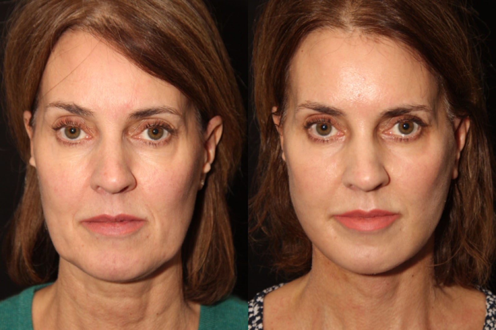 Facelift Surgeon in Toronto | Solomon Facial Plastic