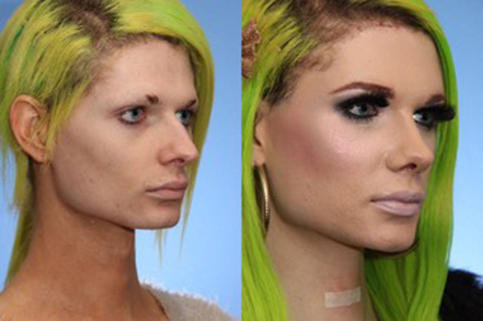 Facial Feminization Surgery Toronto - Solomon Facial Plastic