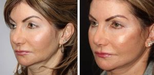 Deep Plane Facelift Surgery in Toronto