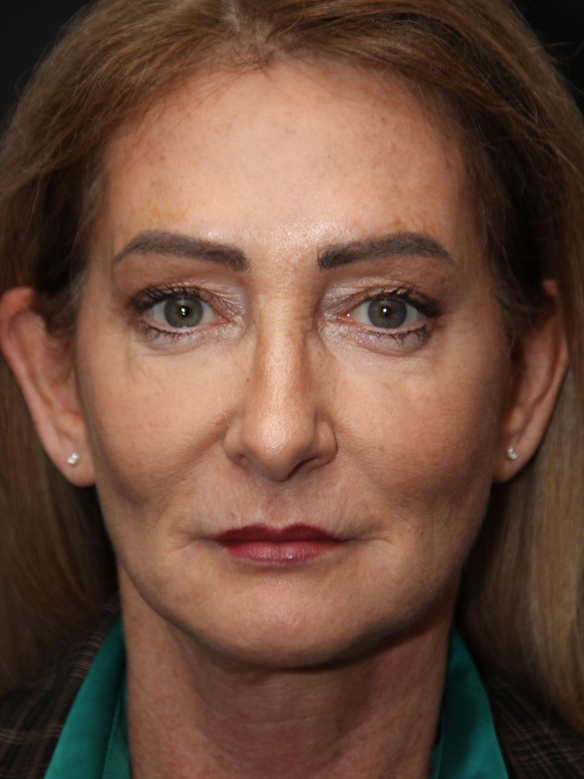 FACELIFT PATIENT 38 - Solomon Facial Plastic