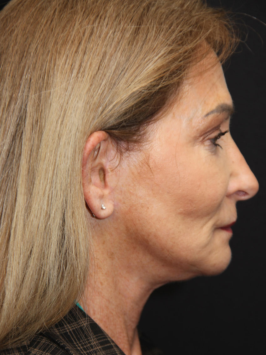 FACELIFT PATIENT 38 - Solomon Facial Plastic