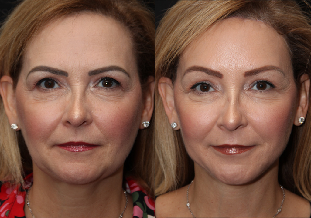 Eyebrow Lift Procedure in Toronto | Solomon Facial Plastic