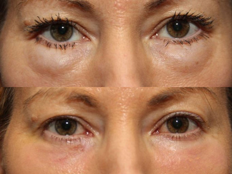 Eyelid surgery toronto store