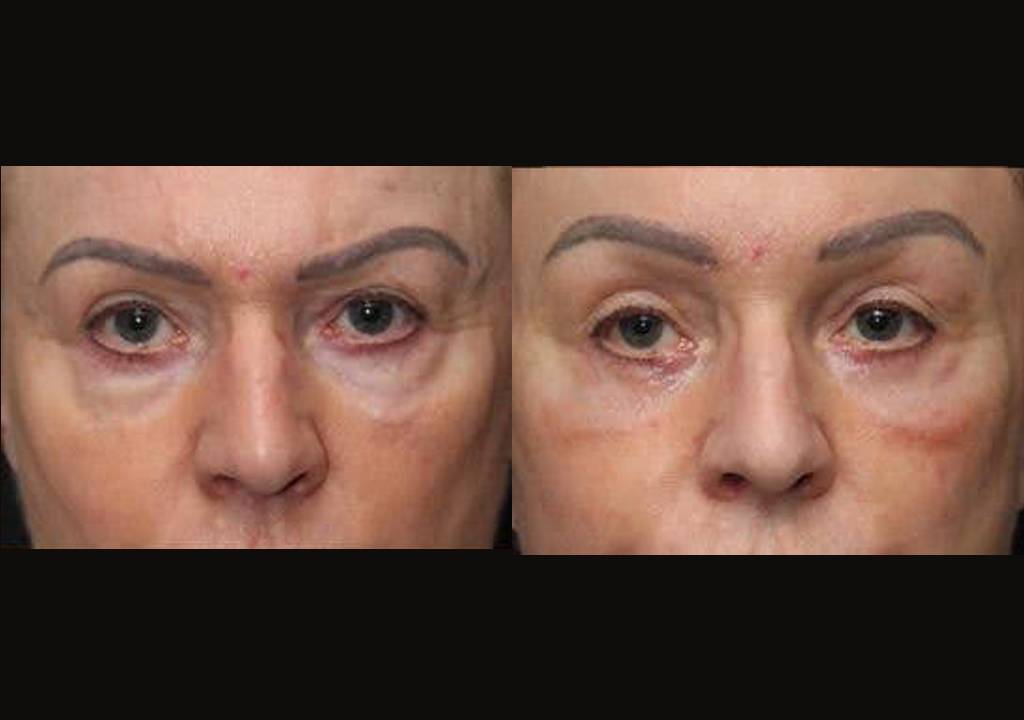 Eyebrow Lift Procedure in Toronto | Solomon Facial Plastic