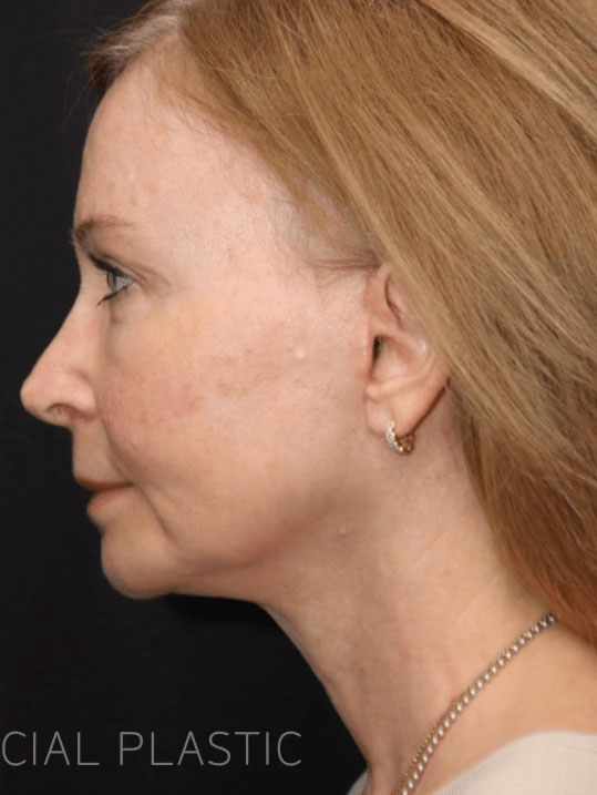 FACELIFT PATIENT may fold 1 - Solomon Facial Plastic
