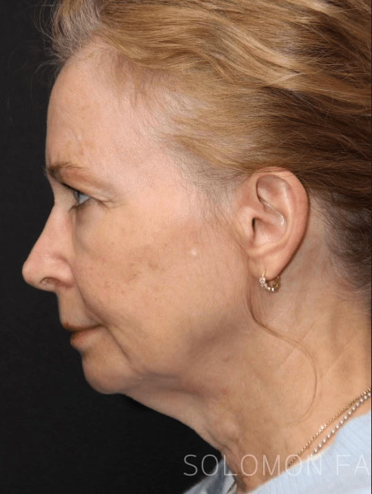 FACELIFT PATIENT may fold 1 - Solomon Facial Plastic