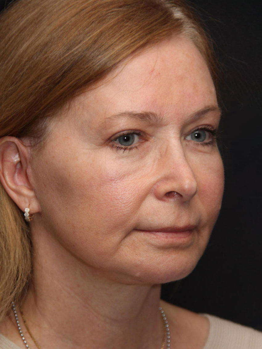 FACELIFT PATIENT may fold 1 - Solomon Facial Plastic