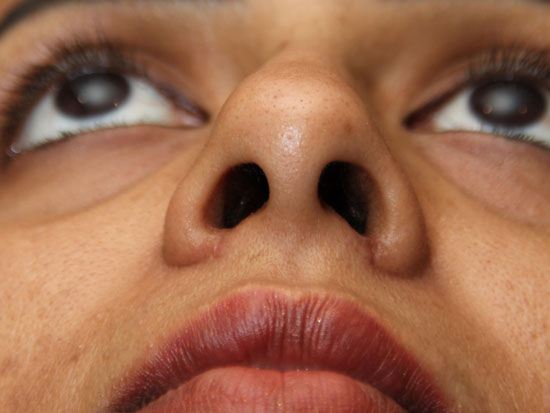 Rhinophyma Before & After Photos - Dr. Solomon
