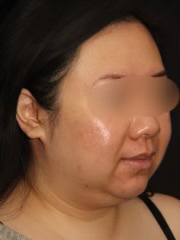 NECK LIPO 2024 May P6 - Solomon Facial Plastic