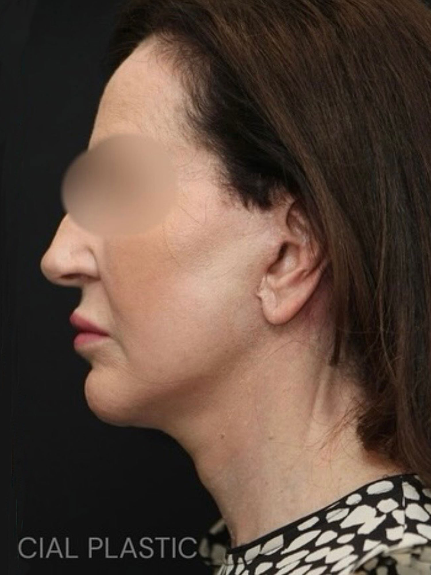 Facelift Patient 7 Nov 2025 - Solomon Facial Plastic