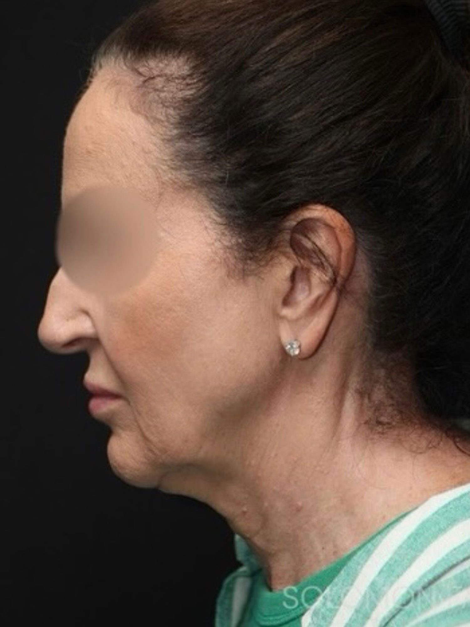 Facelift Patient 7 Nov 2025 - Solomon Facial Plastic