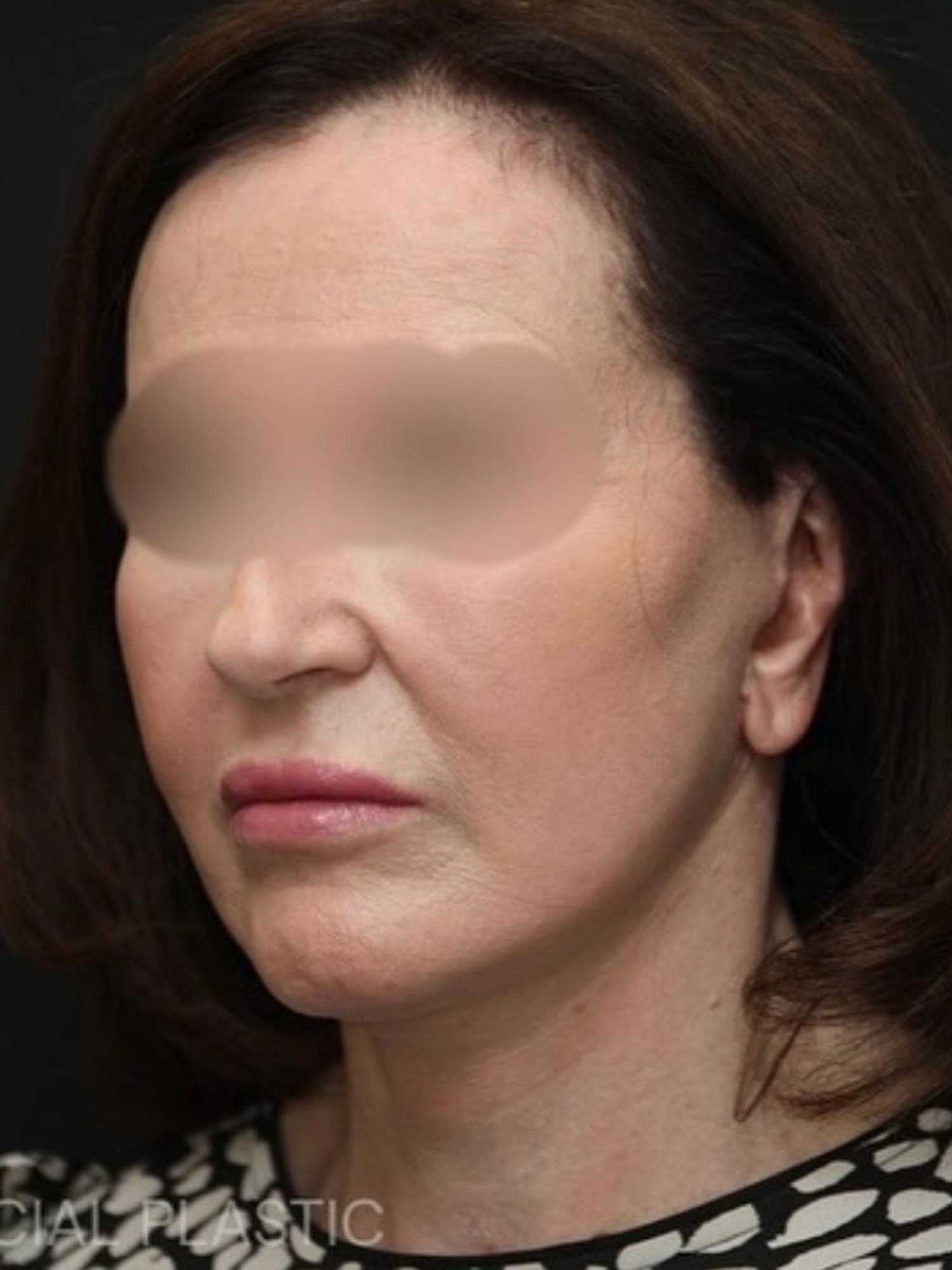 Facelift Patient 7 Nov 2025 - Solomon Facial Plastic